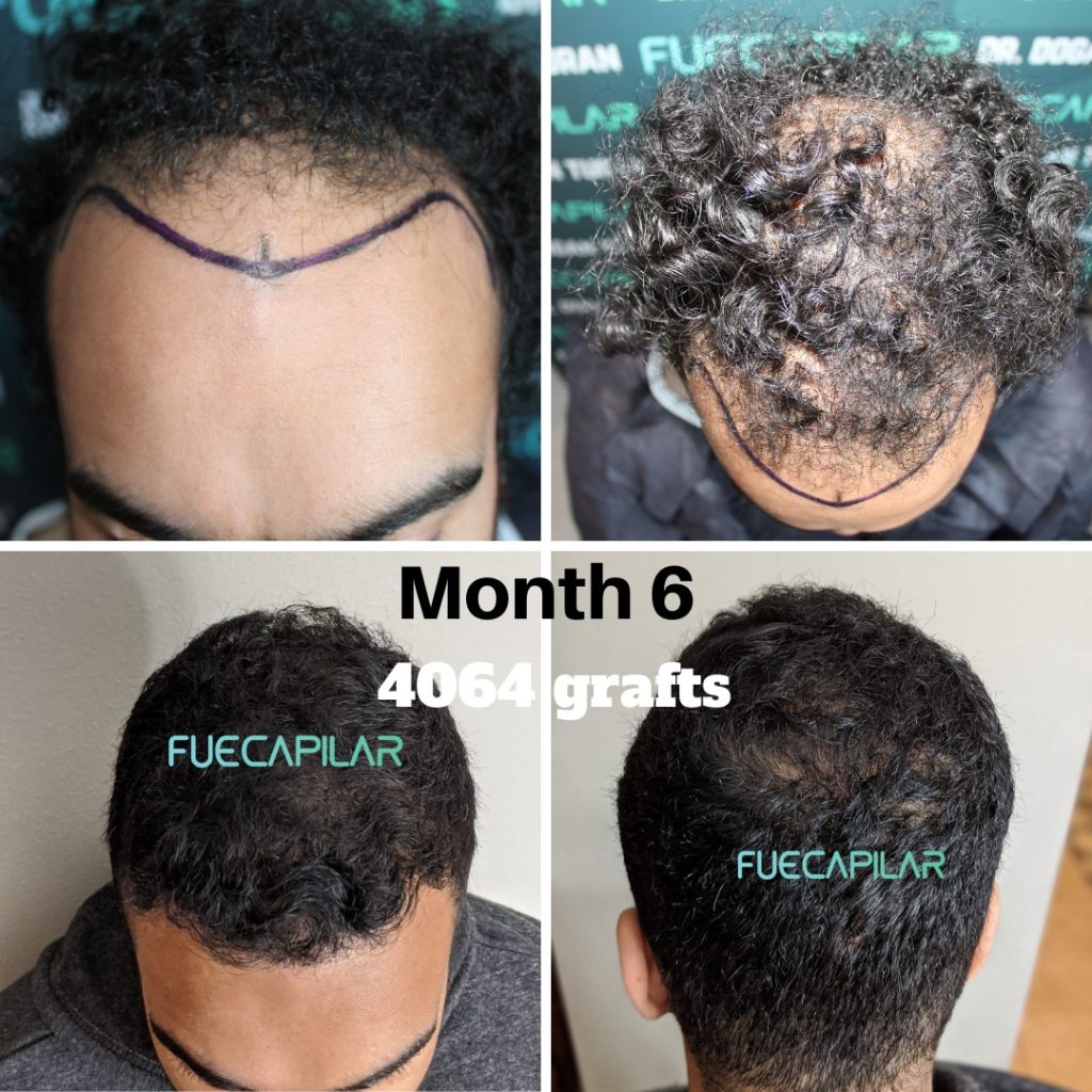 Why does the crown always look thinner after a hair transplant? – Fue ...